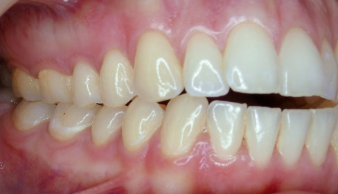 Der offene Biss: Ätiologie und Fallbeispiele genetischer Faktoren – ZWP ...