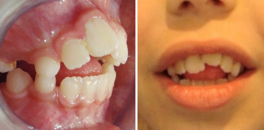 Der offene Biss: Ätiologie und Fallbeispiele genetischer Faktoren – ZWP ...