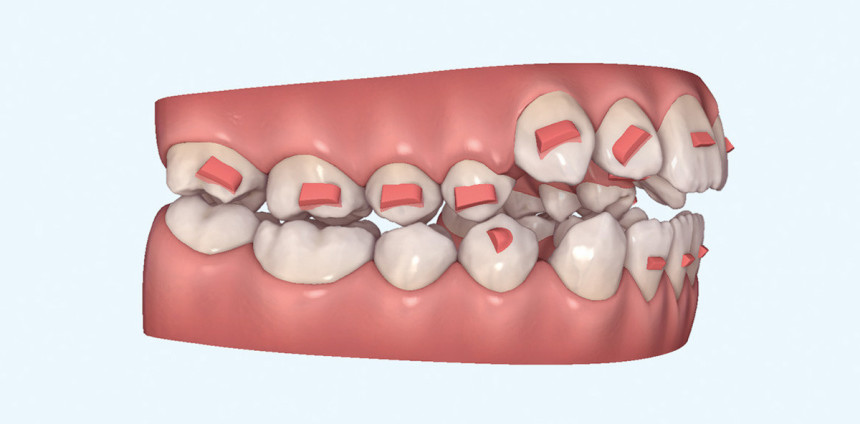 Korrektur frontal offener Bisse mithilfe von Alignern – ZWP online ...