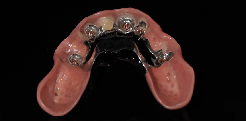 Neue Erkenntnisse: Design von wurzelstiftverankerten Hybridprothesen ...