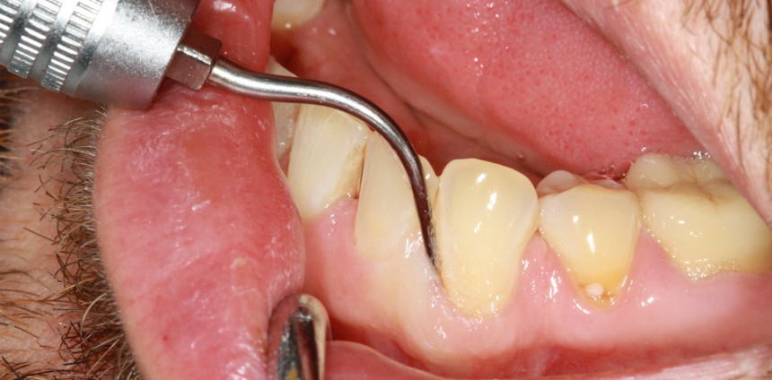 Leitlinie zur Parodontitistherapie „Subgingivale Instrumentierung ...