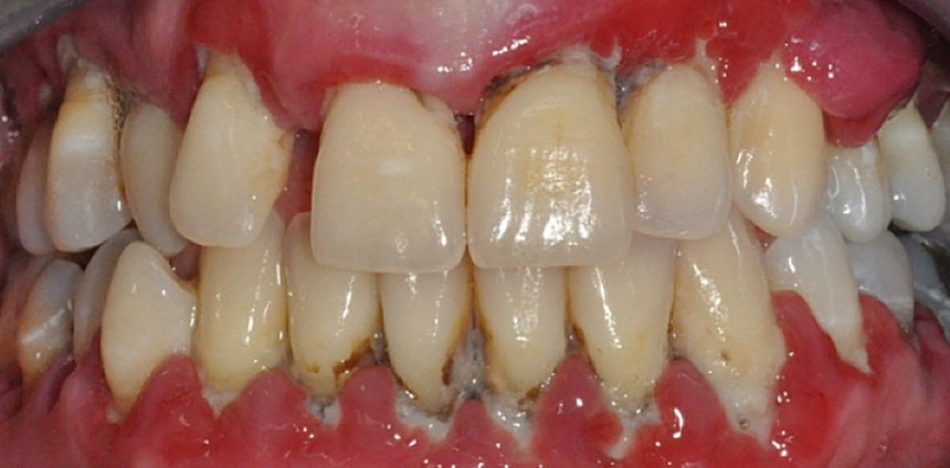 Langzeitergebnisse bei aggressiver Parodontitis – ZWP online – das ...