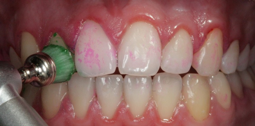 Politur der Zahnoberflächen – Weshalb, wie und womit? – ZWP online ...