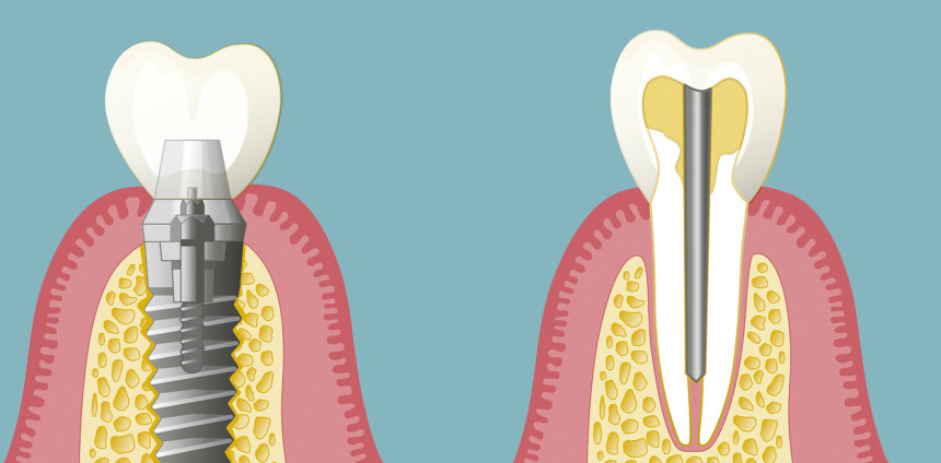 Stiftzahn oder Implantat – wo ist der Unterschied? – ZWP online – das ...