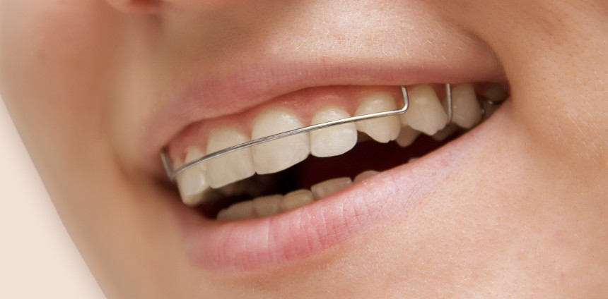 Blog: Wiederbefestigung Eines Festsitzenden Retainers – RWQL