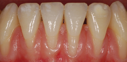 Therapie multipler gingivaler Rezessionen – ZWP online – das ...