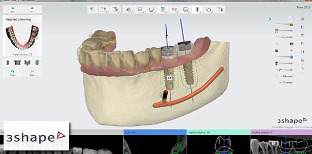 3Shape veröffentlicht Implant Studio™ 2015 Software – ZWP online – das Nachrichtenportal für die ...