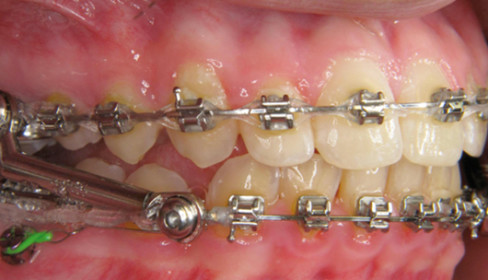 Lingualtechnik und Beneslider – ohne großen Aufwand kombinierbar – ZWP ...