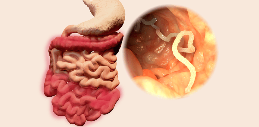 Über den Mund: Ärzte befreien Patienten von 1,90 m langem Bandwurm ...