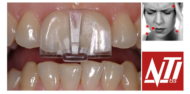 NTI-tss Schiene: Erfolg für die Funktionstherapie in der Praxis – ZWP ...