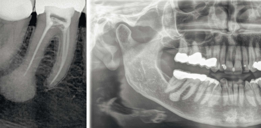 Aus der Praxis: Das komplexe Odontom – ZWP online – das ...