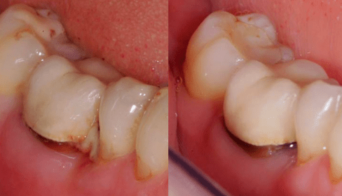 Aggressive und chronische Parodontitis – ZWP online – das ...