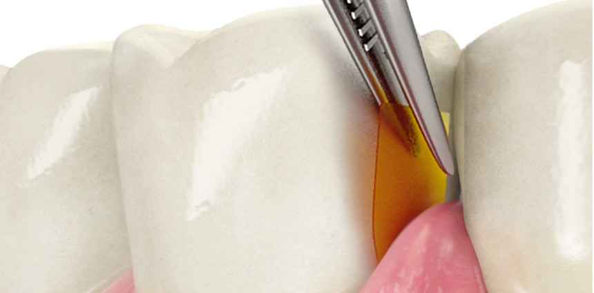 Sicher und wirksam gegen Parodontitis – ZWP online – das ...