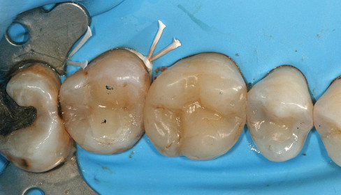 Therapiemöglichkeit einer Pulpanekrose – ZWP online – das ...