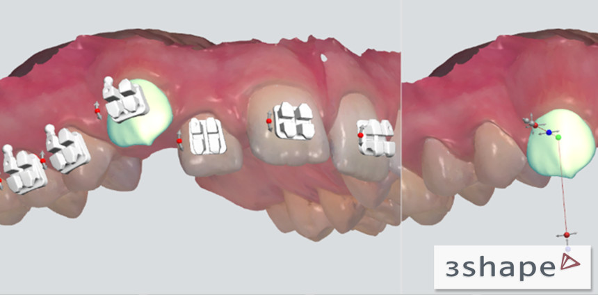 Komfortabel und effizient: Brackets mit digitaler Präzision platzieren – ZWP online – das ...