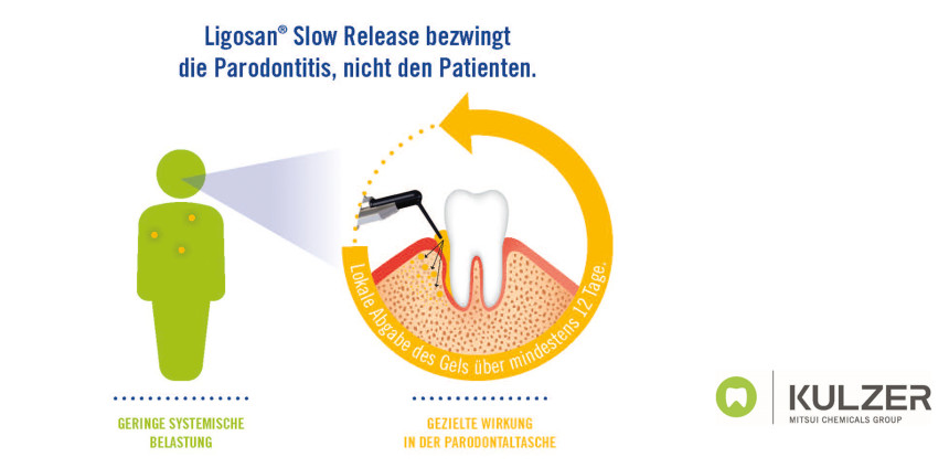 Ligosan – gezielte Wirkung ohne Belastung und Disziplin – ZWP online ...