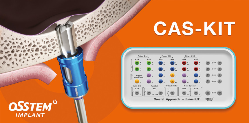 Minimalinvasiver interner Sinuslift bei hoher Sicherheit – ZWP online ...