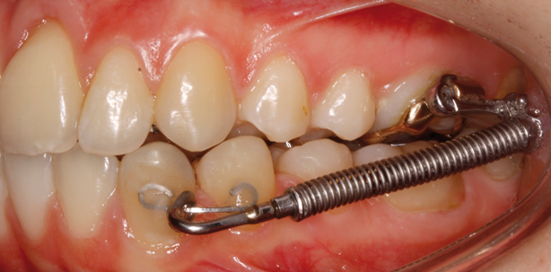 Kieferorthopädie | Funktions-KFO/CMD | ZWP online - Das ...