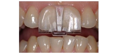 NTI-tss Schiene | ZWP online - Das Nachrichtenportal für die Dentalbranche