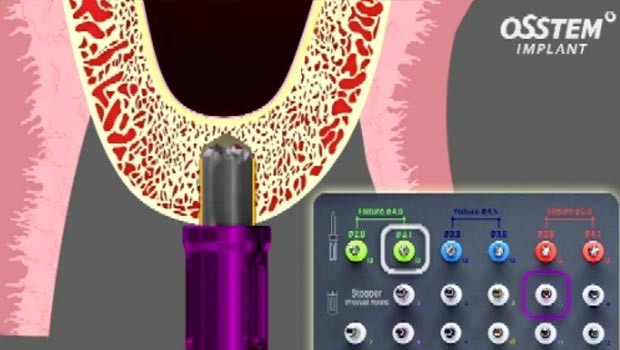 Crestal Approach - Sinus KIT: OSSTEM CAS-KIT – ZWP online – das ...