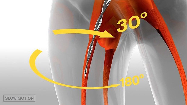 Sendoline S1 System für eine vereinfachte Wurzelkanalaufbereitung – ZWP ...