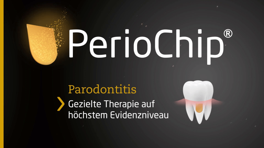 Webinar – Was Sie schon immer zu PerioChip® wissen wollten – ZWP online ...